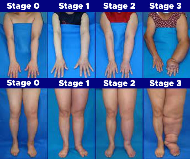 リンパ浮腫（Lymphedema） | 三国ゆう整形外科|大阪市淀川区阪急三国駅近くの整形外科|リハビリテーション科・リウマチ科・骨粗鬆症外来