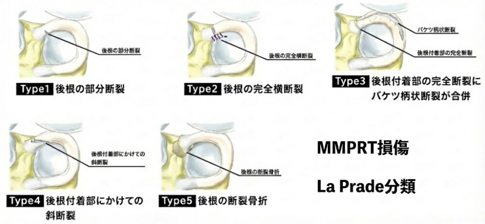 内側半月板後根断裂（MMPRT） | 三国ゆう整形外科|大阪市淀川区阪急三国駅近くの整形外科|リハビリテーション科・リウマチ科・骨粗鬆症外来